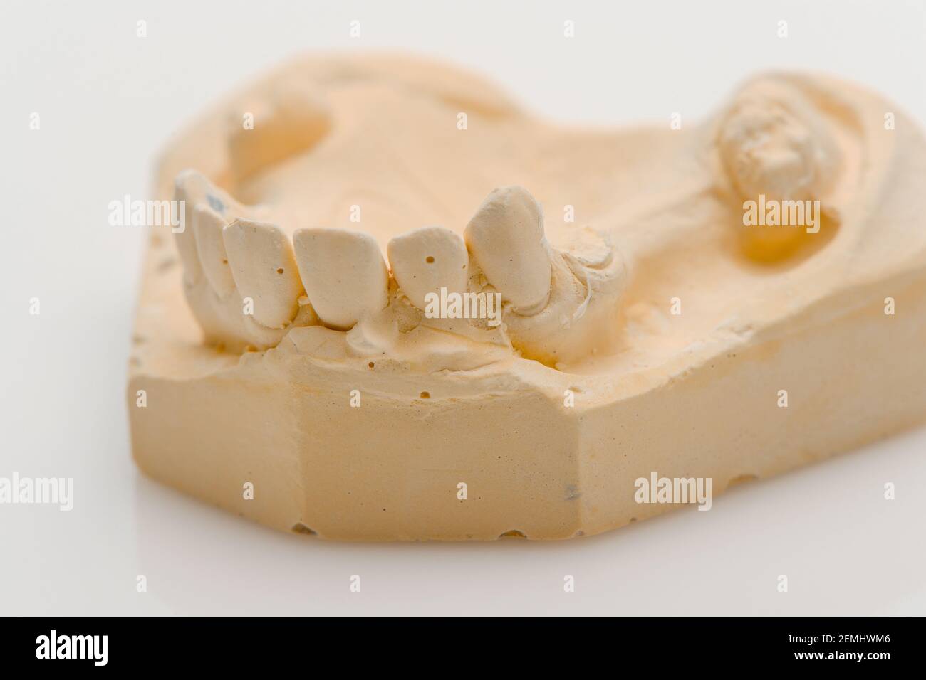 Set of pictures with a Partial denture cast and denture showing missing ...