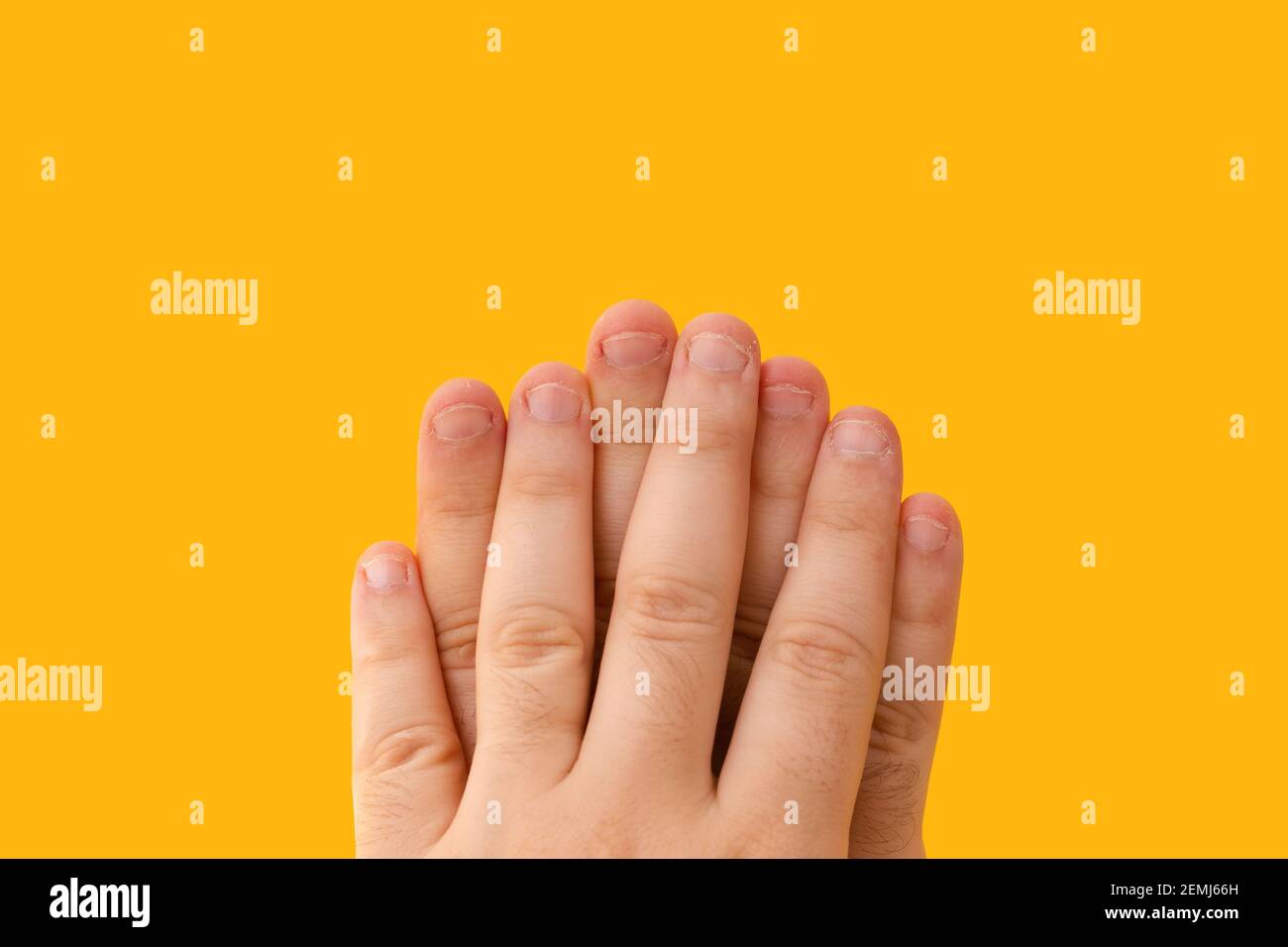 Close up Male fingers with bitten, gwaned, chewed or ugly nails, a Bit ...
