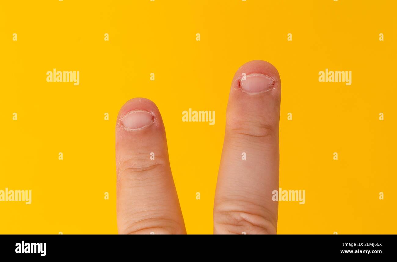 Chewed nails hi-res stock photography and images - Alamy