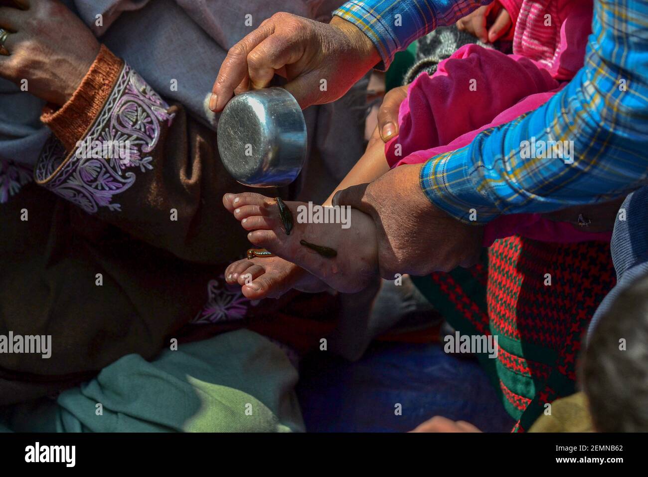 A young patient seen with leeches on her foot during the leech therapy ...