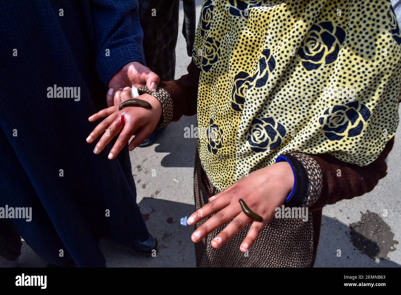 A patient seen with leeches on her hands during the leech therapy ...