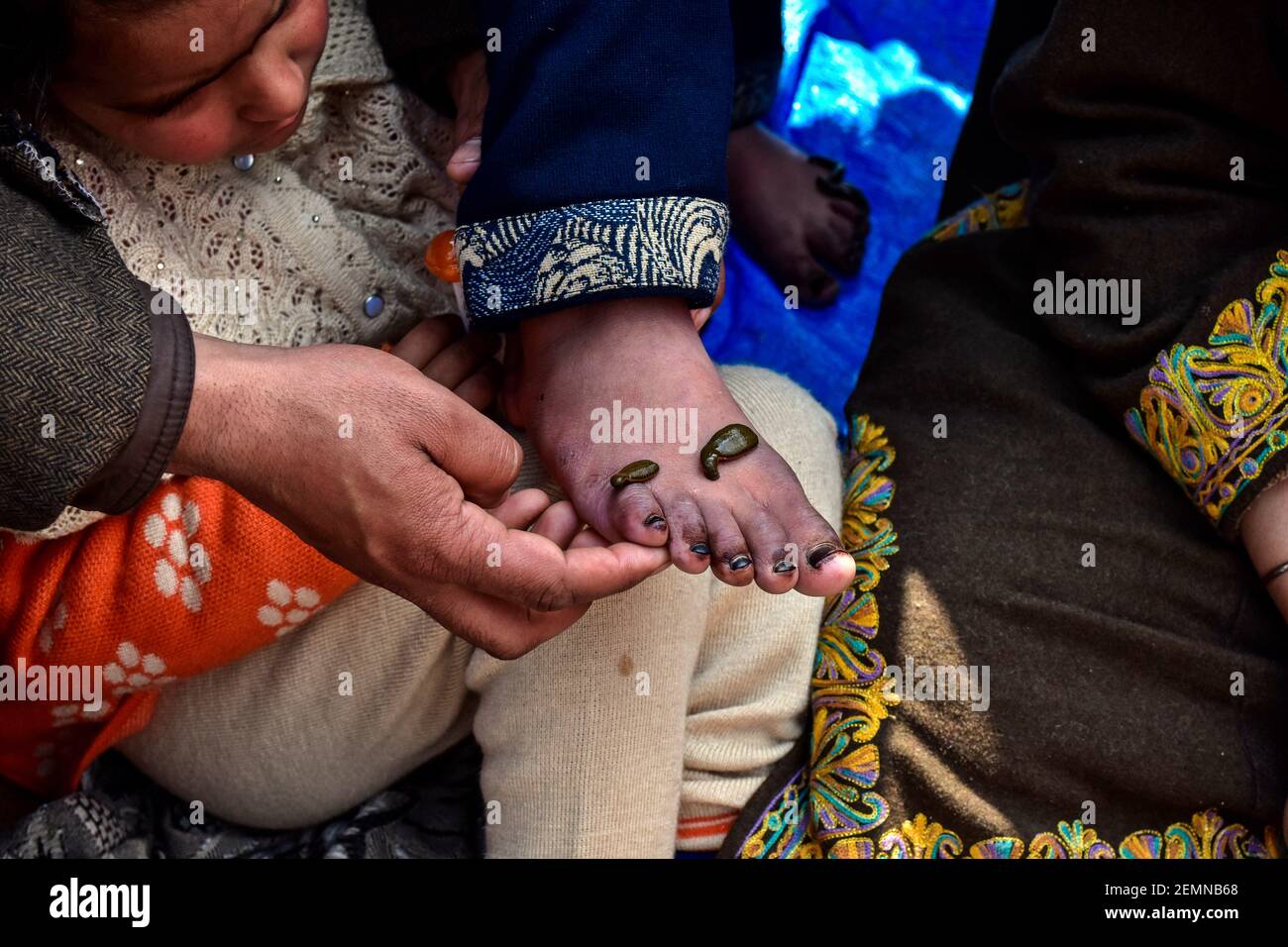 A patient seen with leeches on her foot during the leech therapy. Every ...