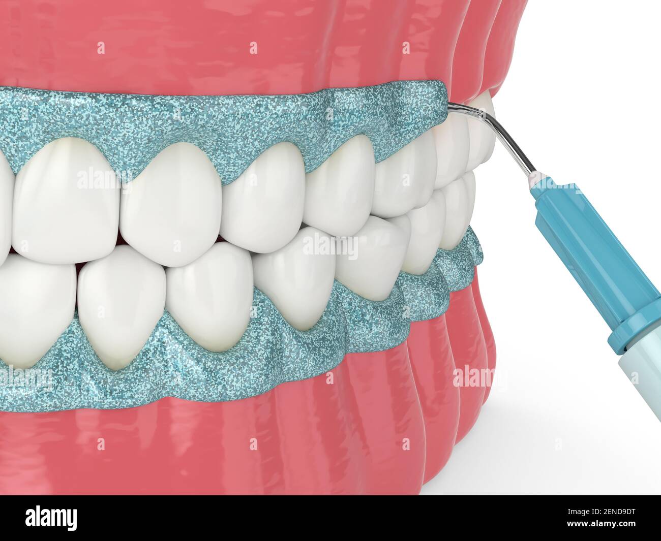 3d render of jaw with gingival mask before teeth bleaching. Protecting ...