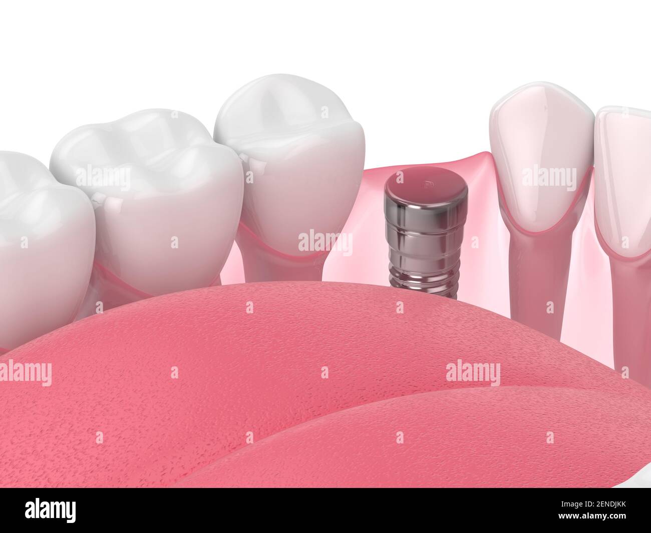 Dental Healing Cap Images at Helen Byrne blog