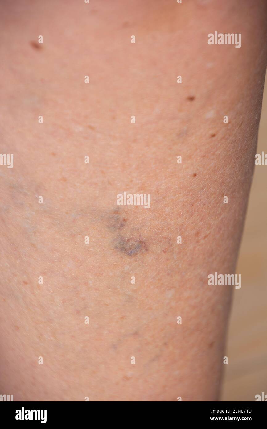 humans spider veins on a hairless lower leg close-up view Stock Photo ...