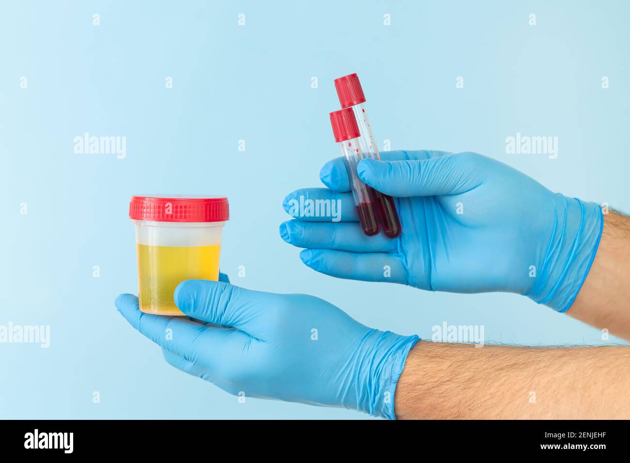Urine sample and blood flask test in doctor or laboratory technician ...