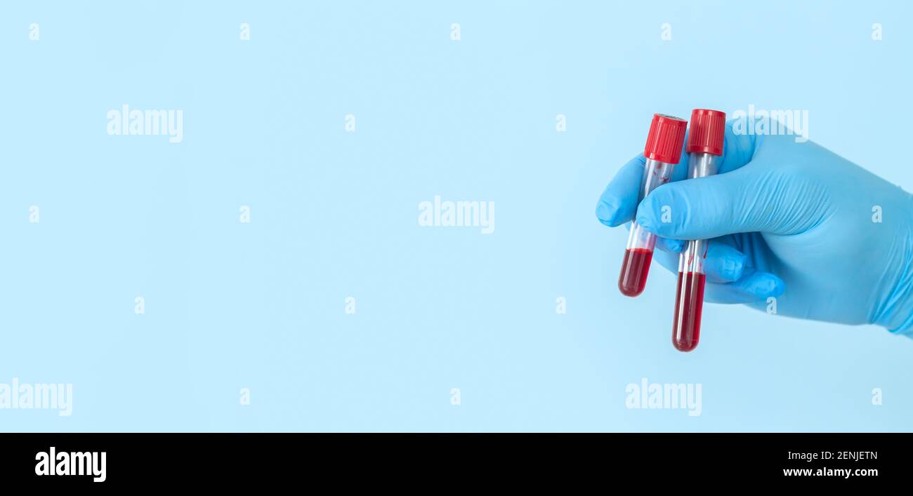 Researcher holding blood sample flasks of patients in laboratory ...