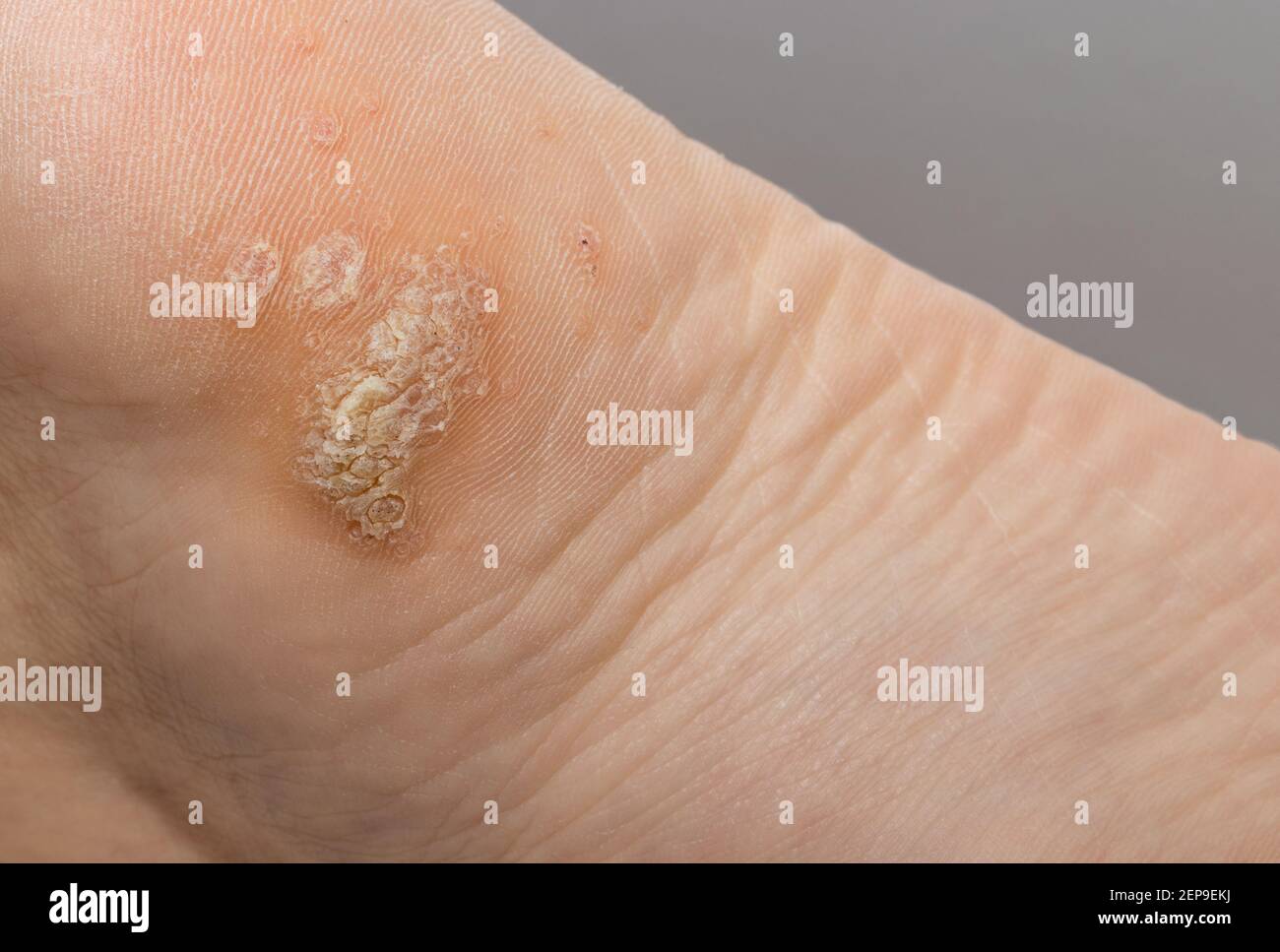 Viral warts on sole foot hi-res stock photography and images - Alamy