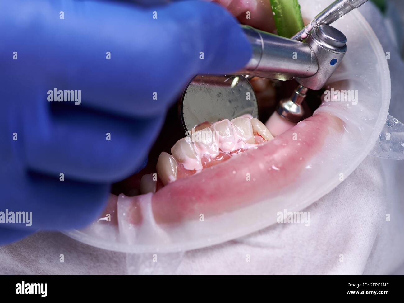 Close up of periodontist using dental polisher and mirror cleaning ...