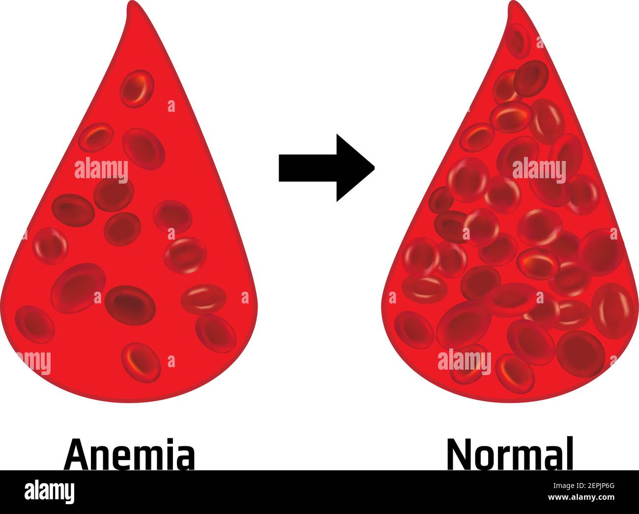 Normal blood cell anemia Stock Vector Images - Alamy