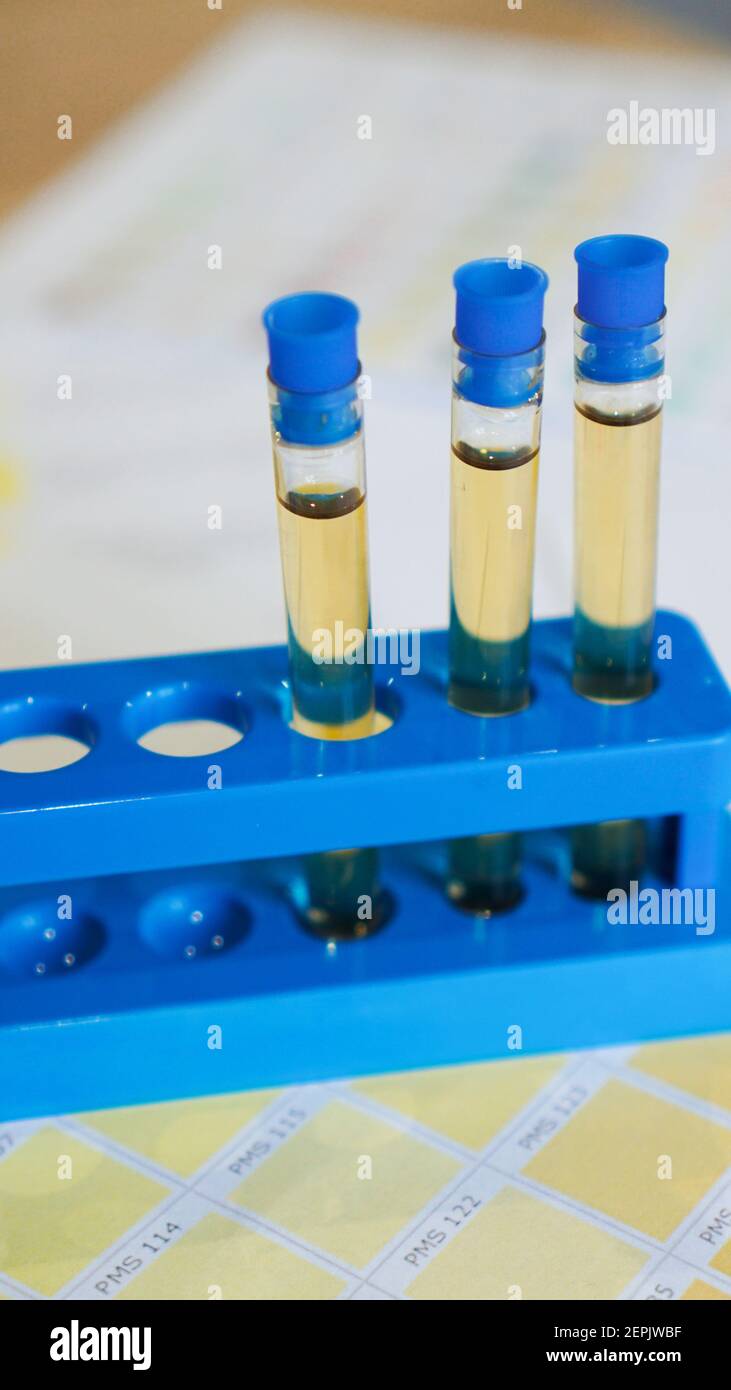 Test tubes with urine on medical color schemes. The concept of ...