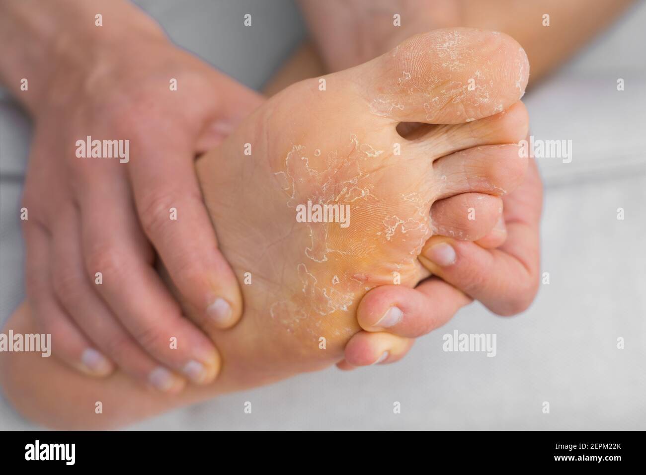 Man's showing his peeling and cracked feet. Fungal infection, eczema ...