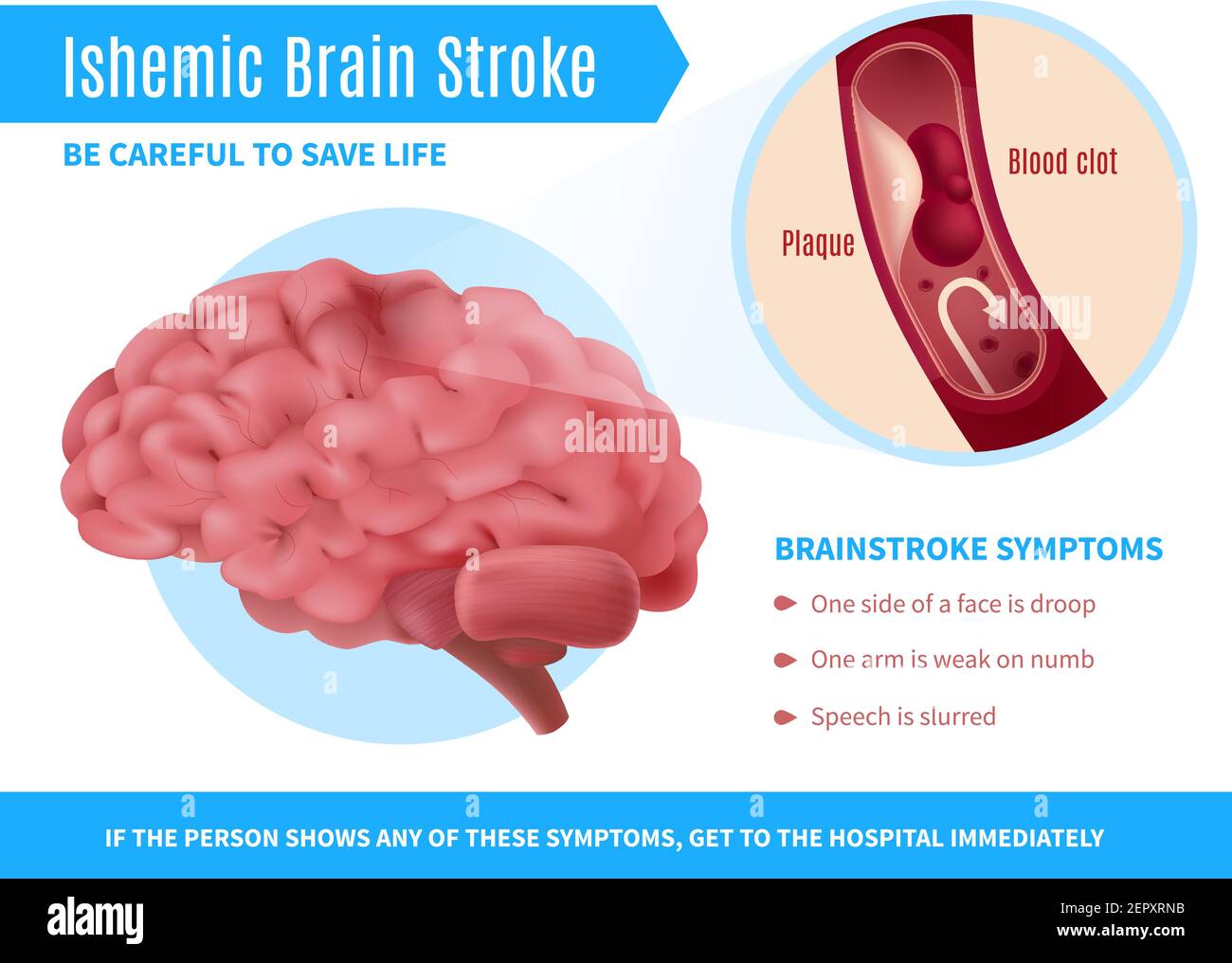 Ischemic brain stroke realistic poster with symptoms list and call to ...
