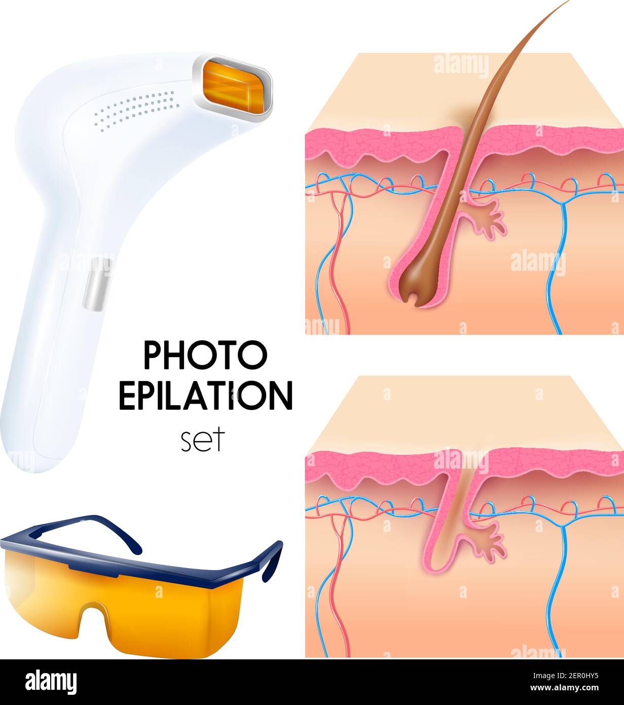 Photo epilation realistic set with epilator protective goggles and ...