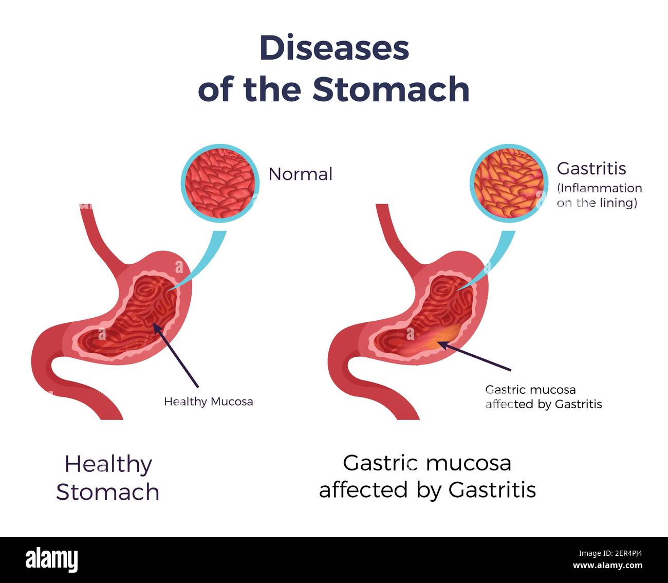 Human normal stomach compared to gastritis affected swollen inflamed ...
