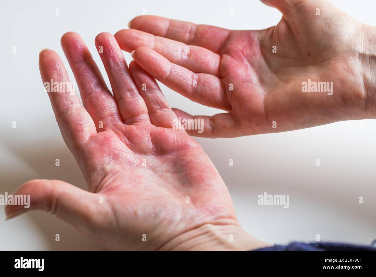 Reddening High Resolution Stock Photography and Images - Alamy