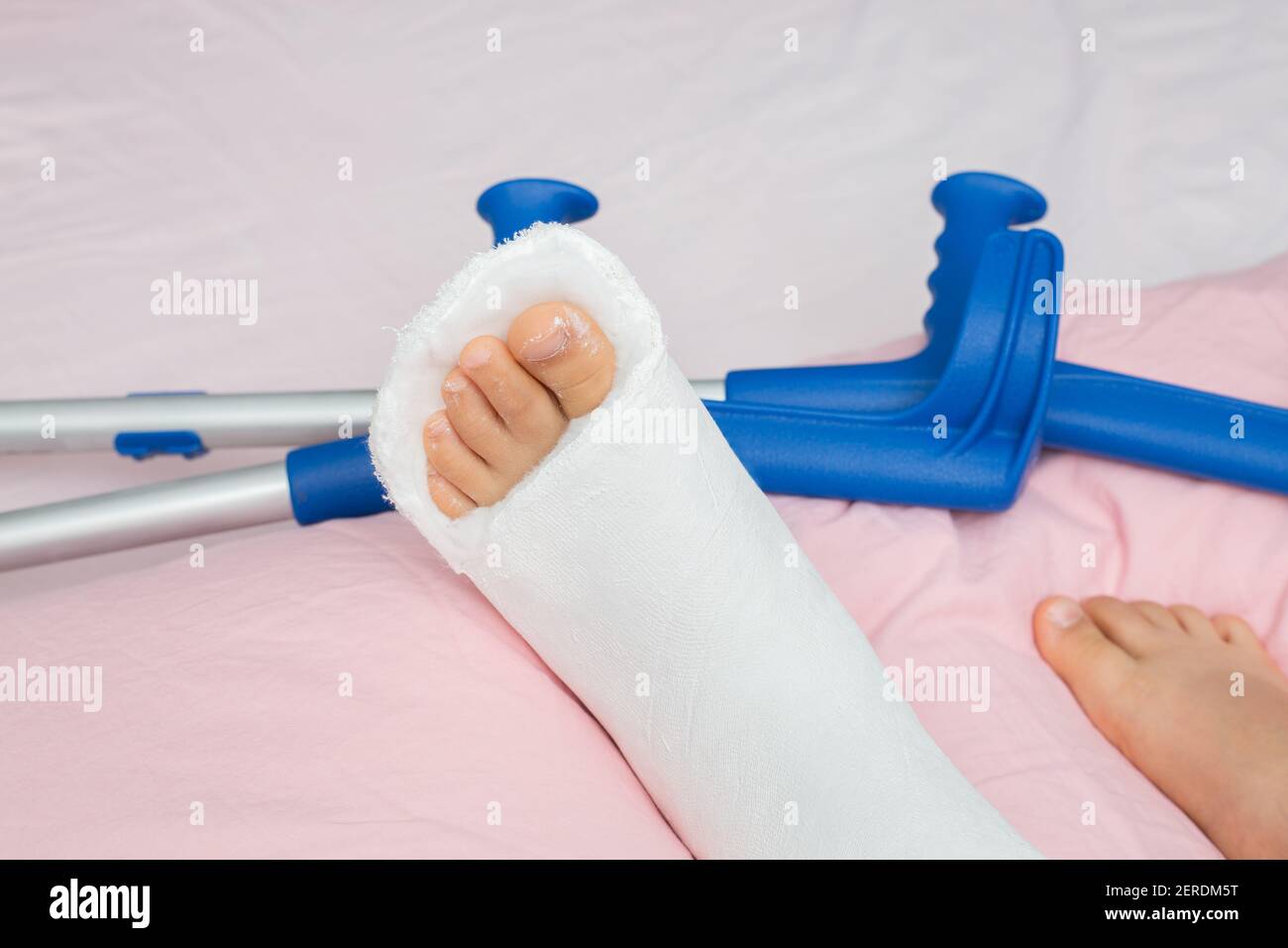 Close up bone fractures on the leg of a child. Children's leg in a cast ...