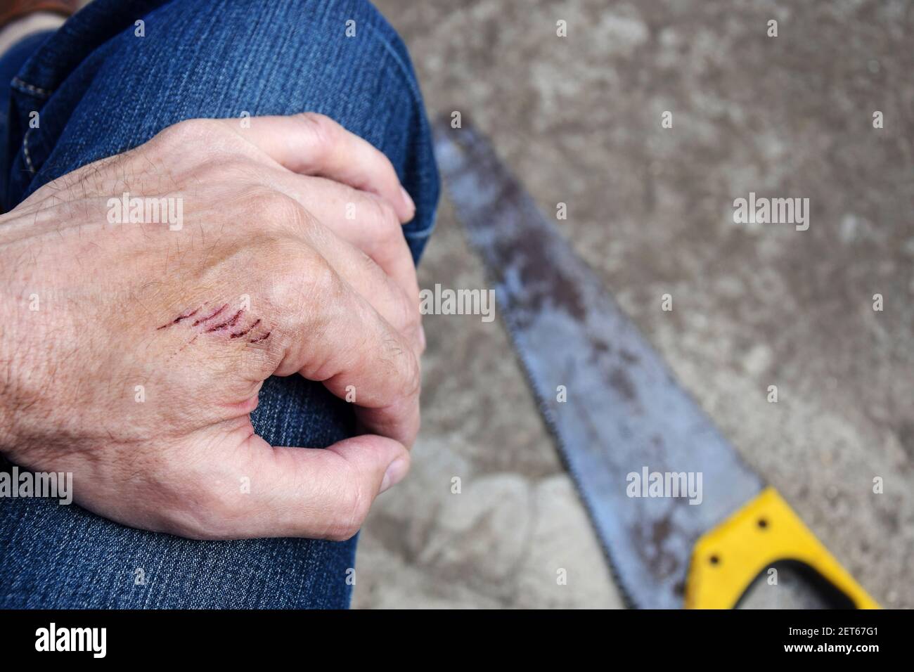 Closeup of man's hand with wound from saw. Fresh scars on the skin with ...