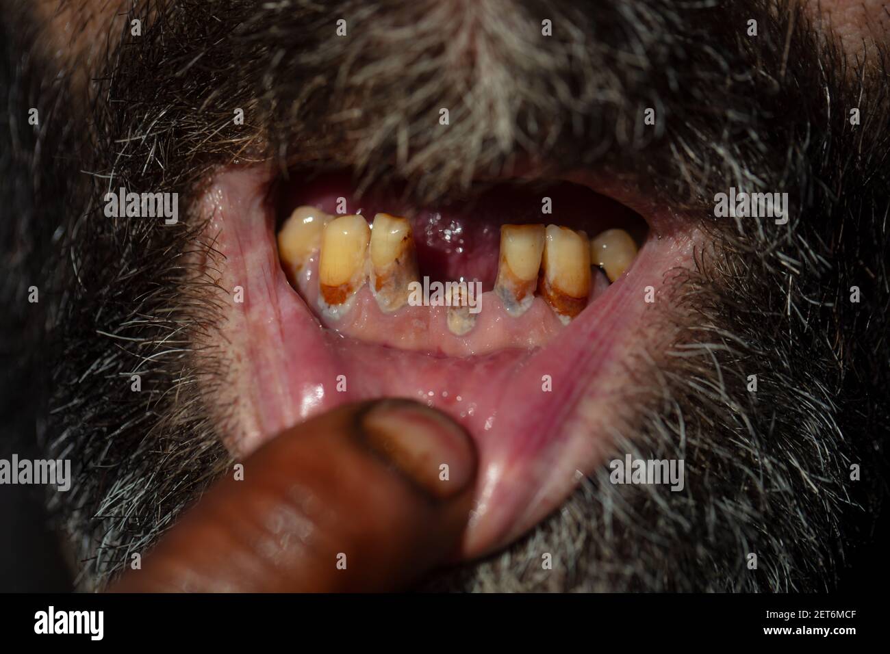 Closeup bad teeth man with caries tartar. The harm of alcohol and ...