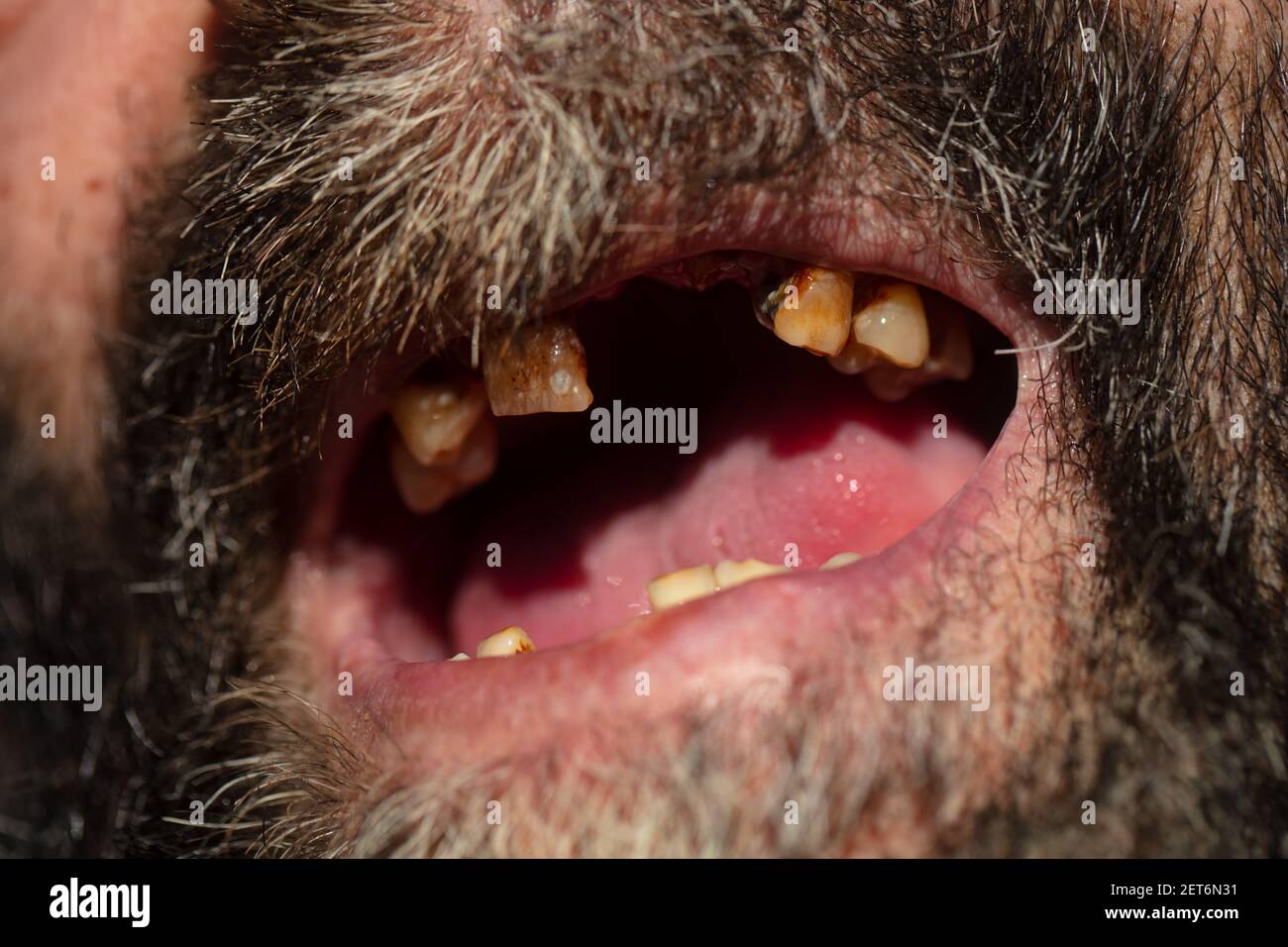 Closeup of unhealthy teeth man with caries tartar in mouth. The harm of ...