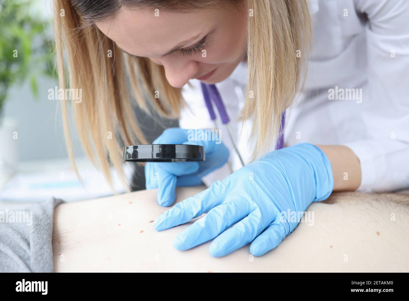Woman doctor examines a patient's birthmark through magnifying glass ...