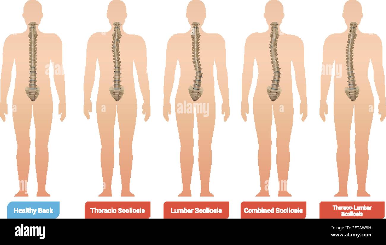 Spinal curvature scoliosis medical infographic images set with ...