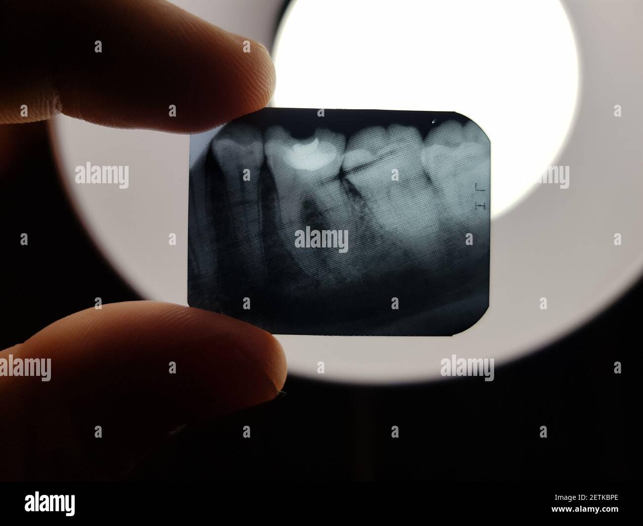 The result of x-ray radiography of the teeth of the oral cavity of the ...