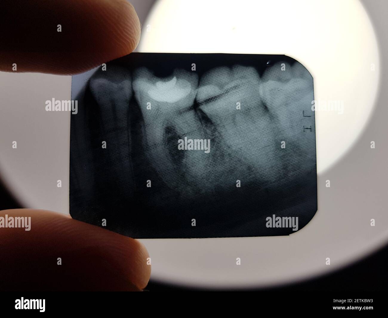 The result of x-ray radiography of the teeth of the oral cavity of the ...