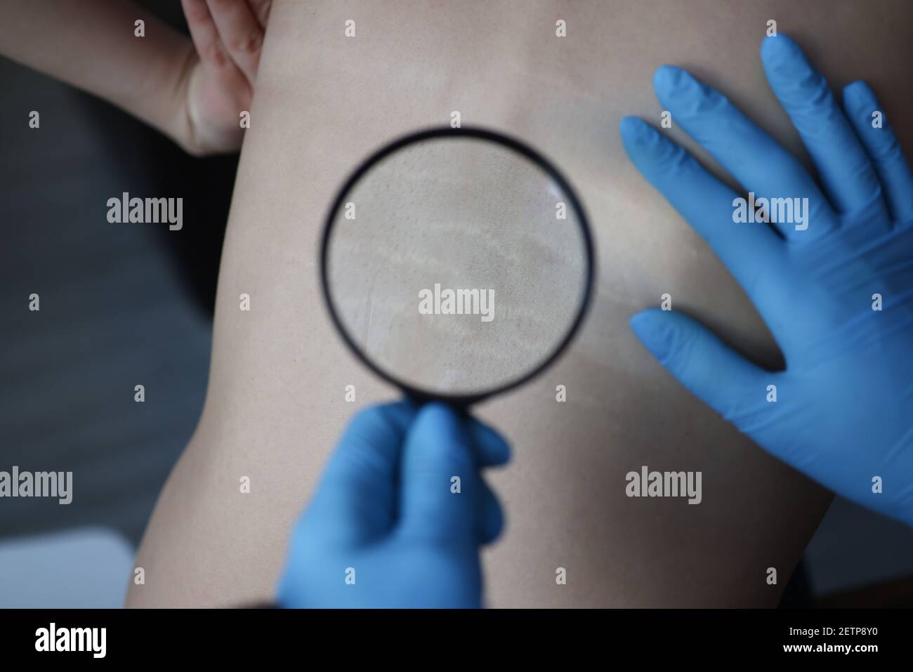 Doctor examining stretch marks on patients back using magnifying glass ...