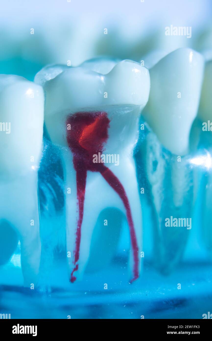 tooth decay going to root canal in teeth teaching medical model Stock ...