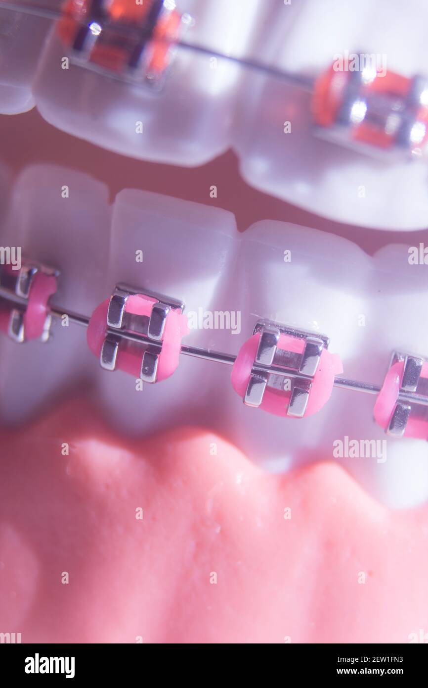Modern metal brackets aligner straighterners used to correct alignment ...