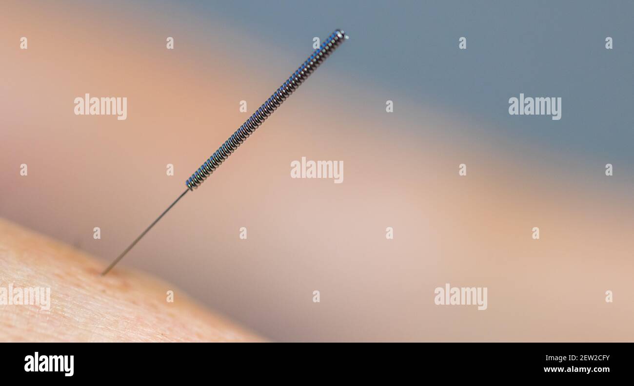 A selective focus shot of acupuncture needle on a man's arm Stock Photo ...