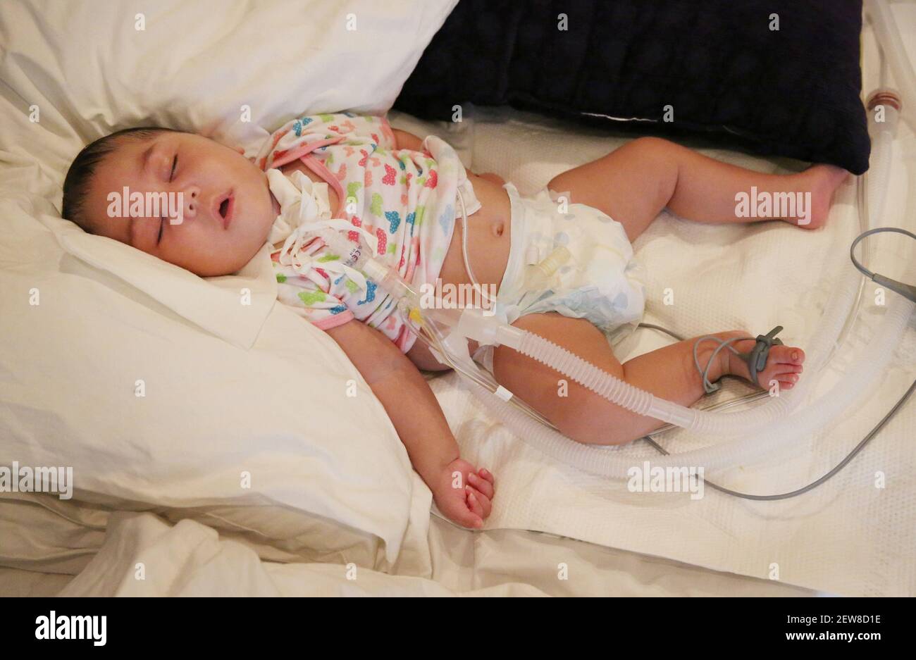 Victoria Malave, nearly 10-months-old, requires a breathing tube ...