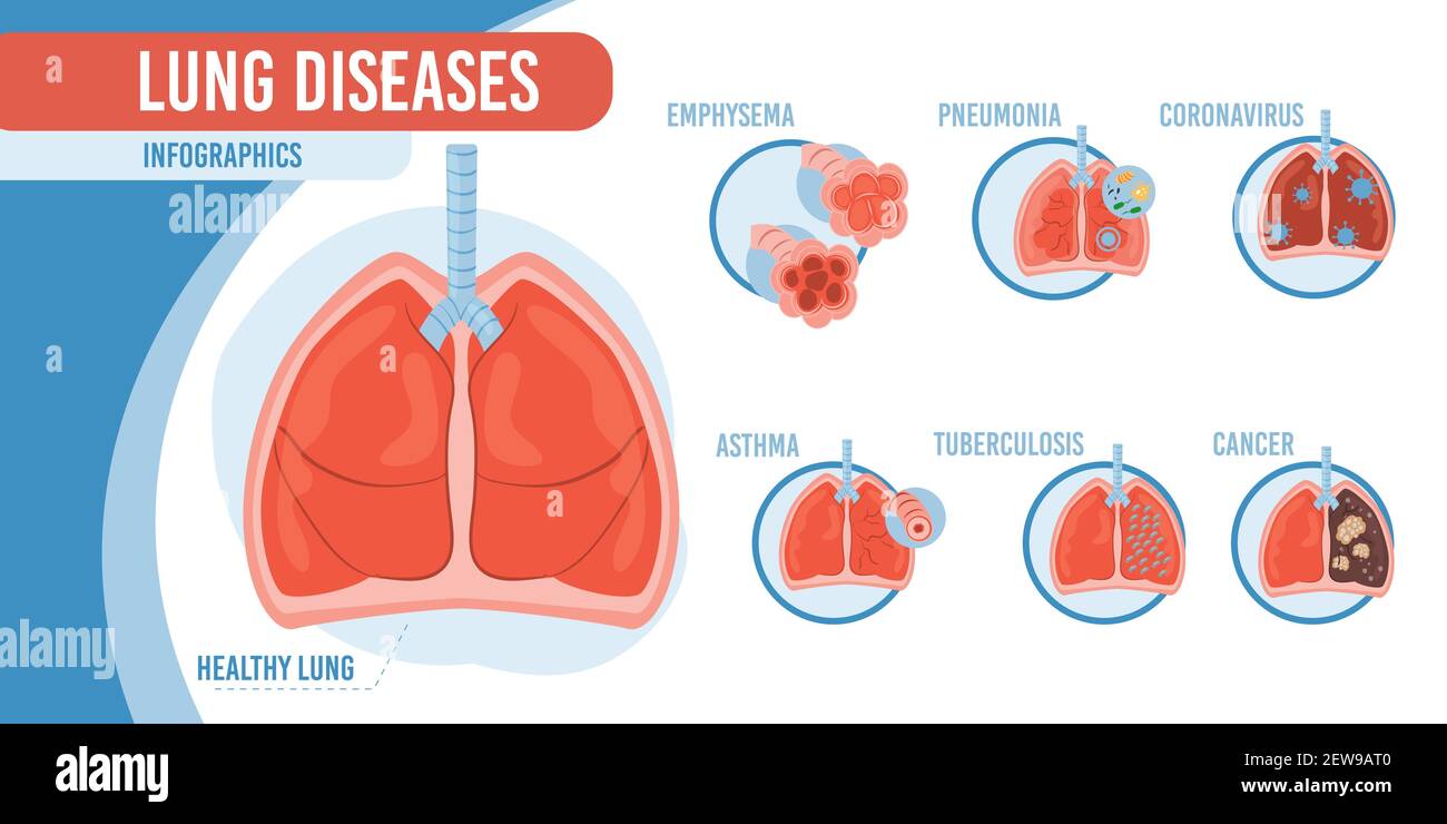 Flat cartoon infographic lungs diseases vector illustration concept ...