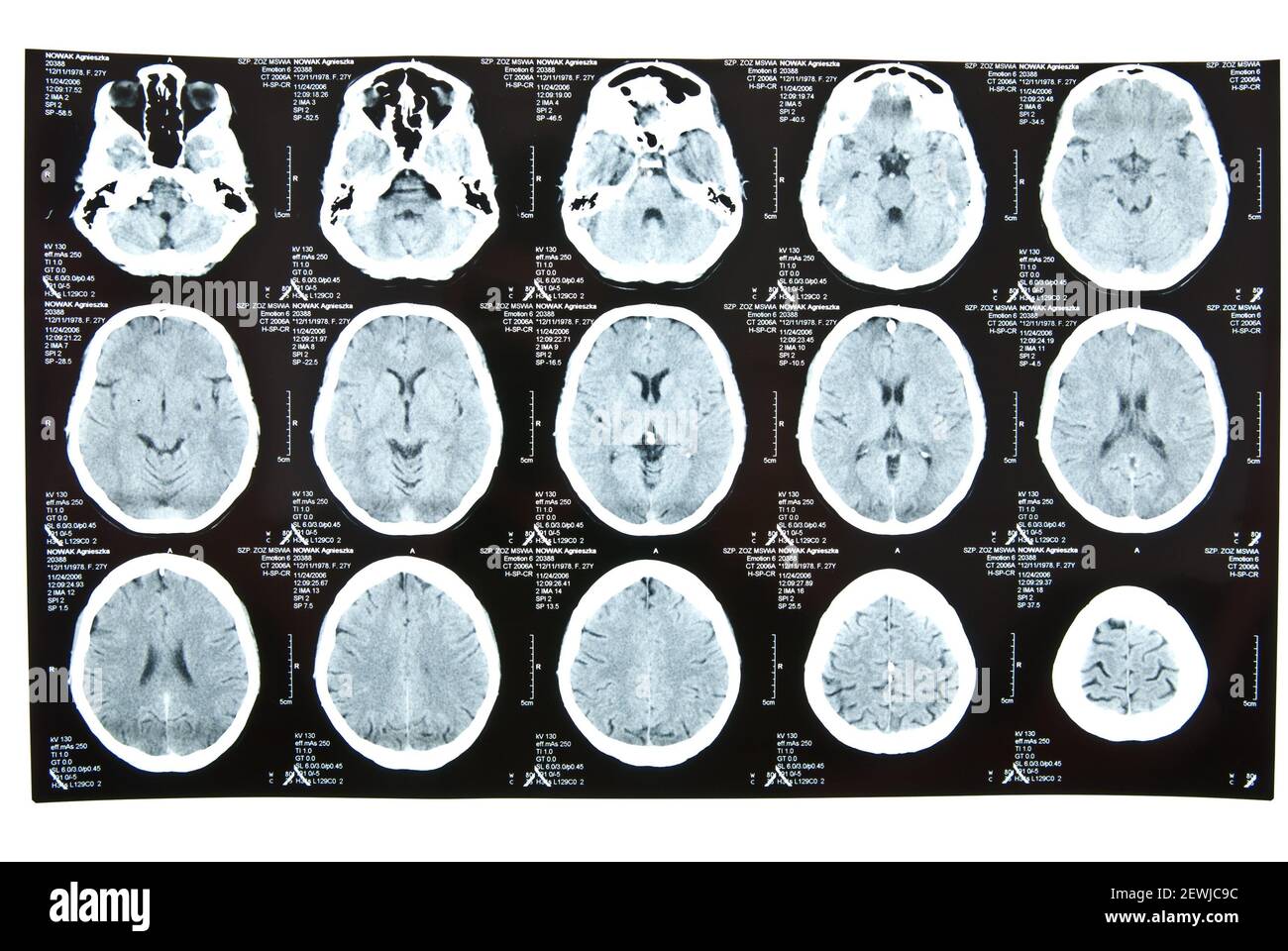 Brain Xray High Resolution Stock Photography and Images - Alamy