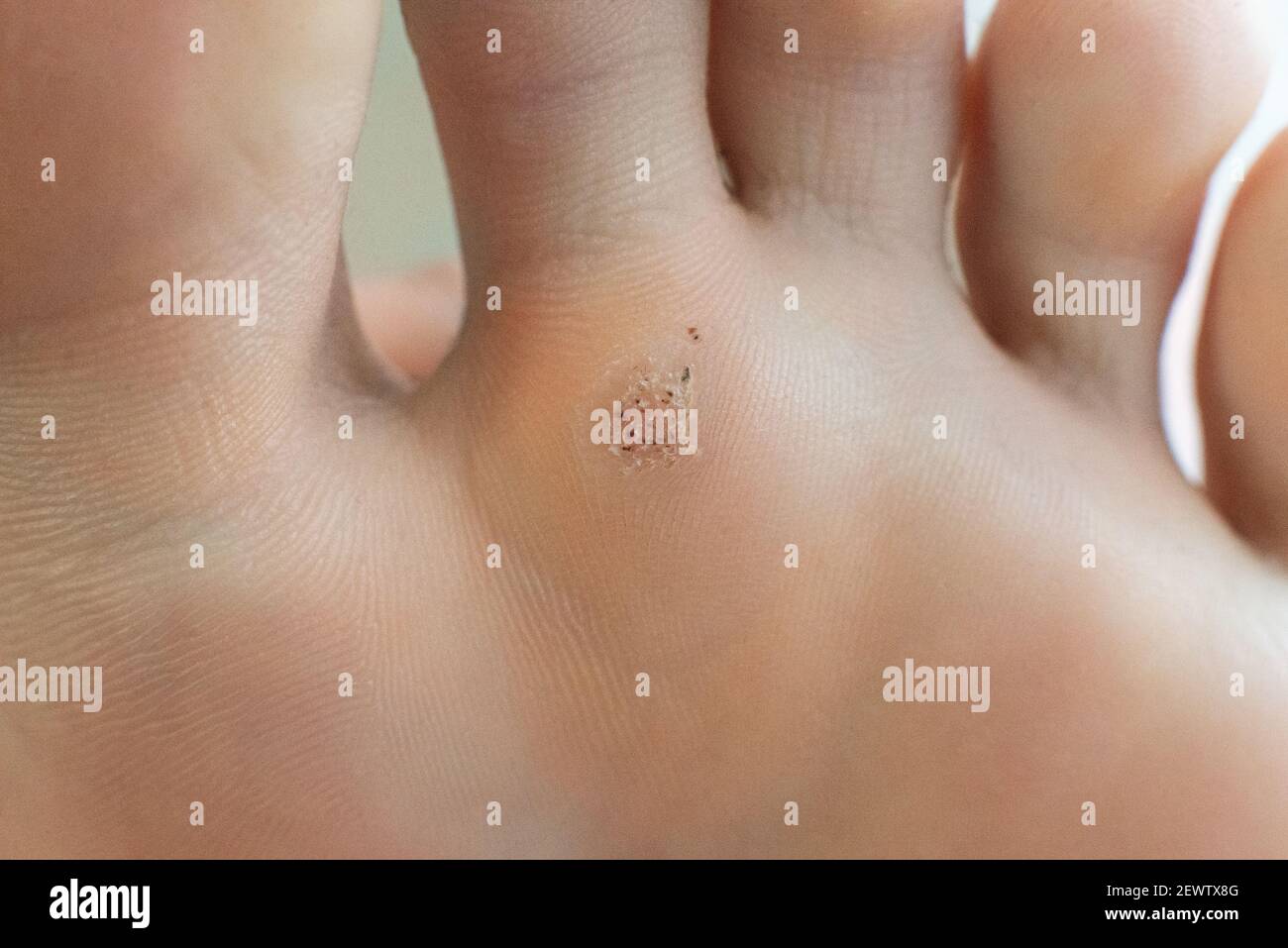 Verruca foot hi-res stock photography and images - Alamy
