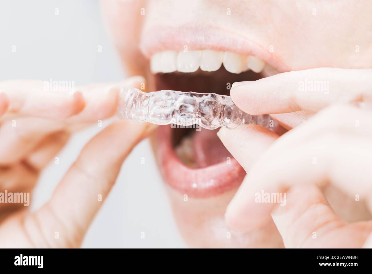 closeup of woman's mouth putting on a transparent retainer with soft ...