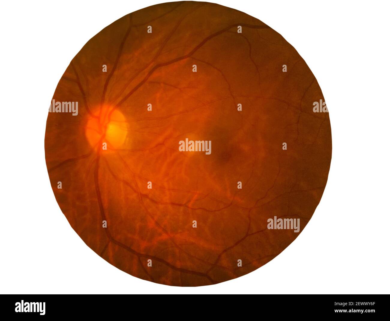 Diabetic Retinopathy Hemorrhage Cut Out Stock Images And Pictures Alamy