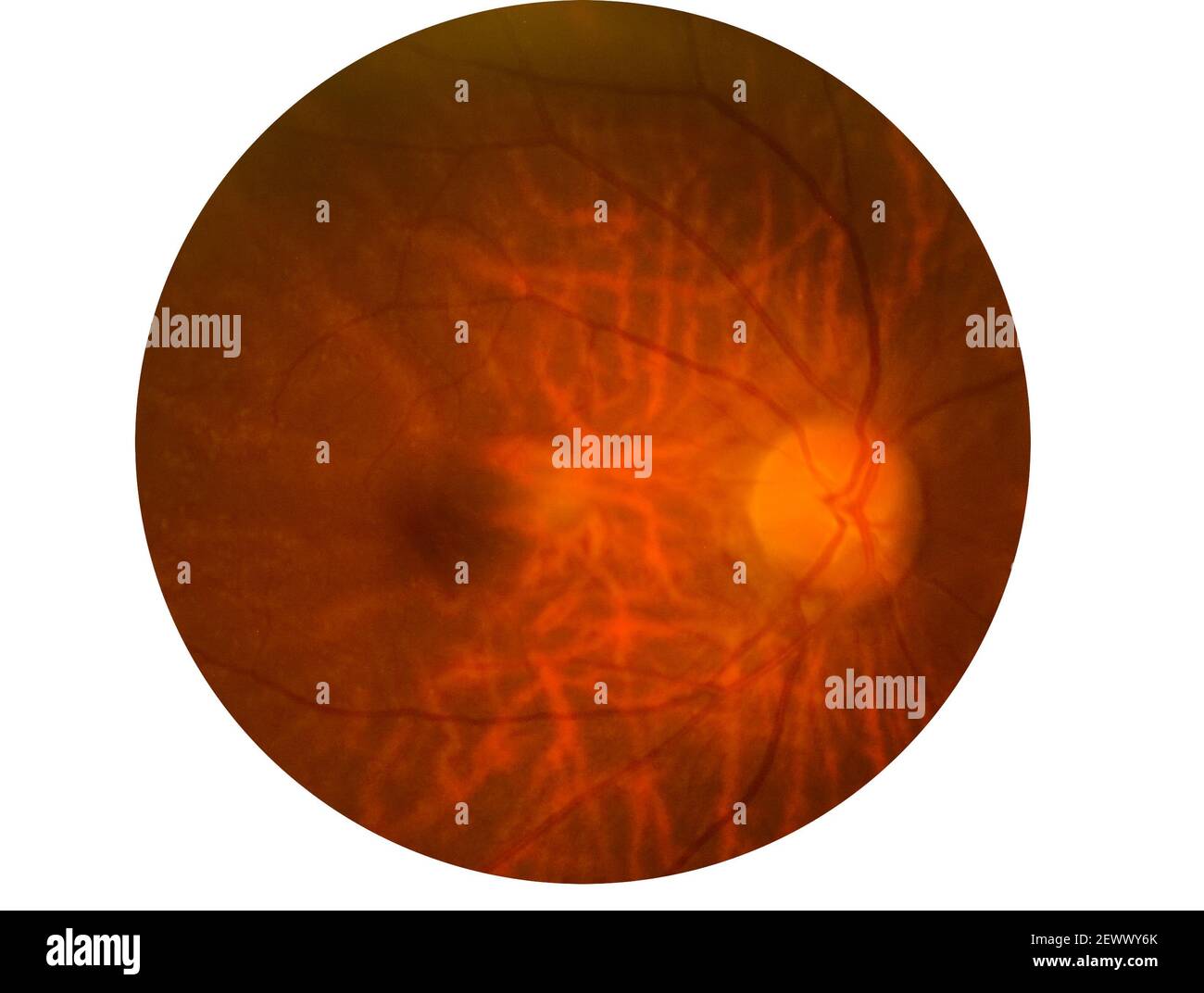 Diabetic retinopathy hemorrhage hi-res stock photography and images - Alamy