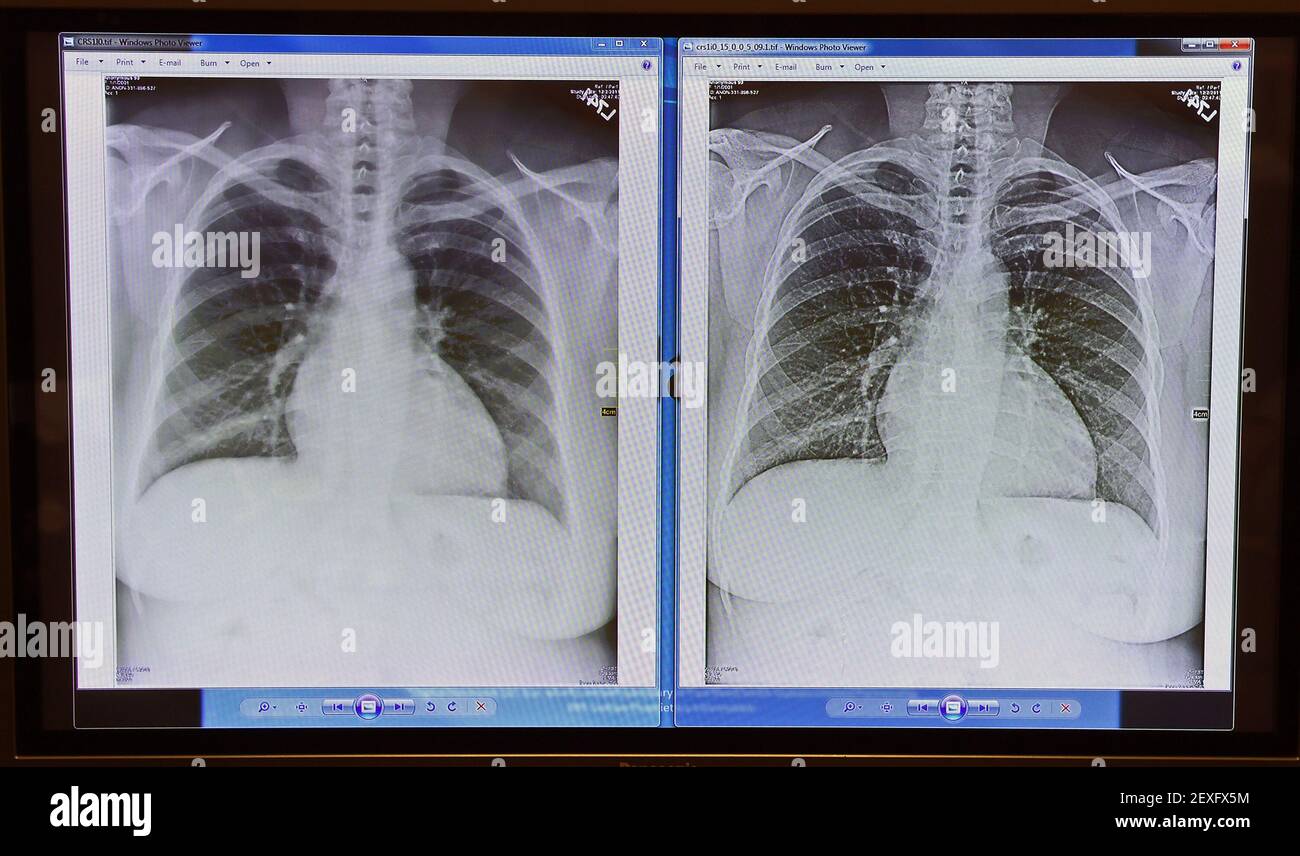 An original X-ray, left, and the improved view of one, right, which was ...