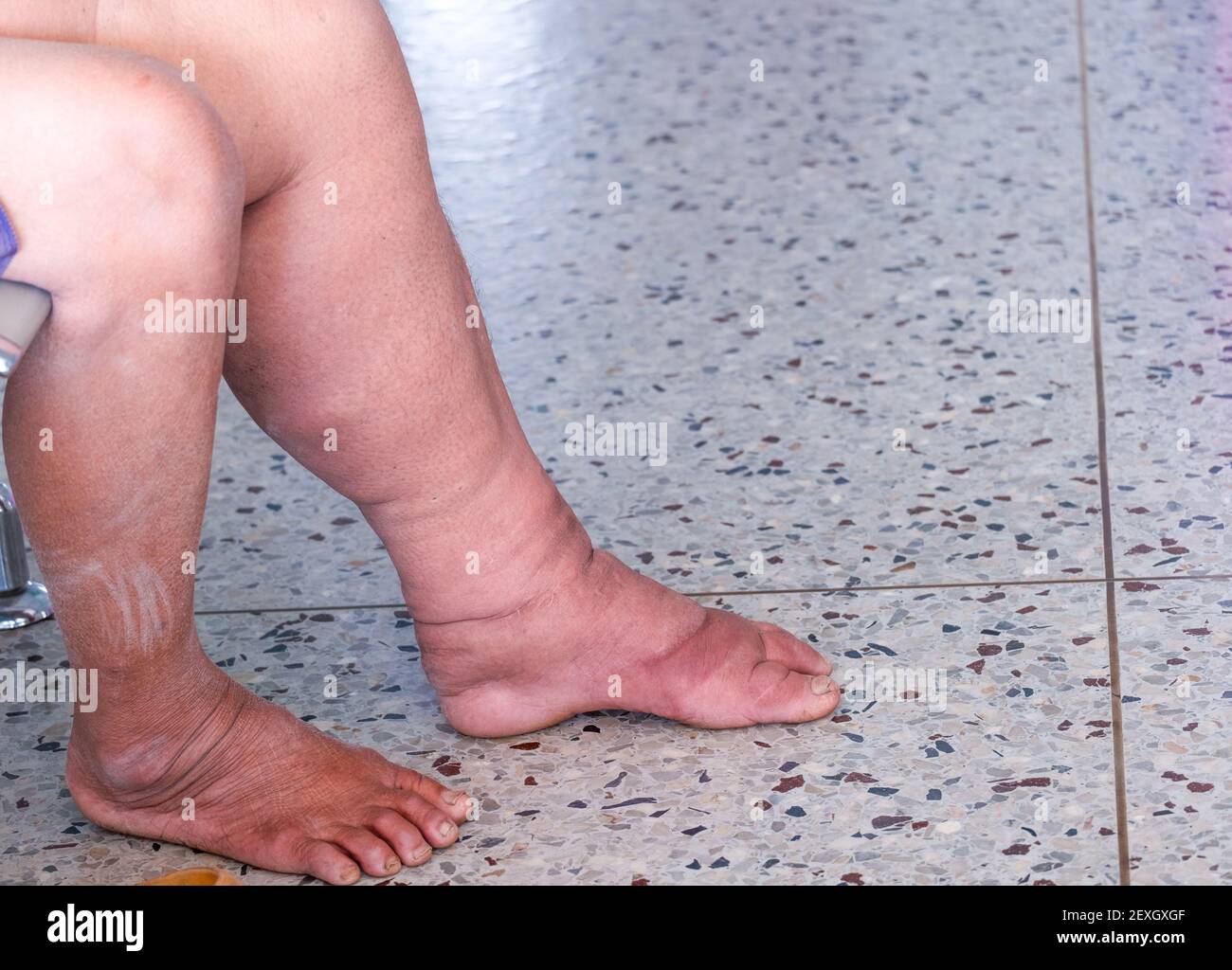 filariasis patient, abnormal lymphatic function patient Stock Photo - Alamy