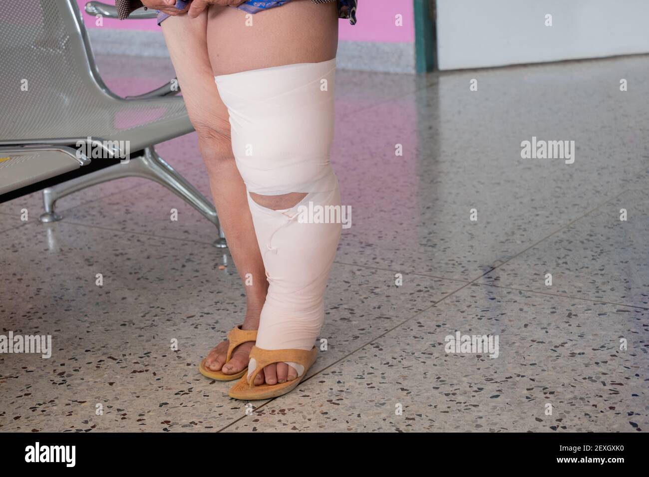 filariasis patient, abnormal lymphatic function patient Stock Photo - Alamy