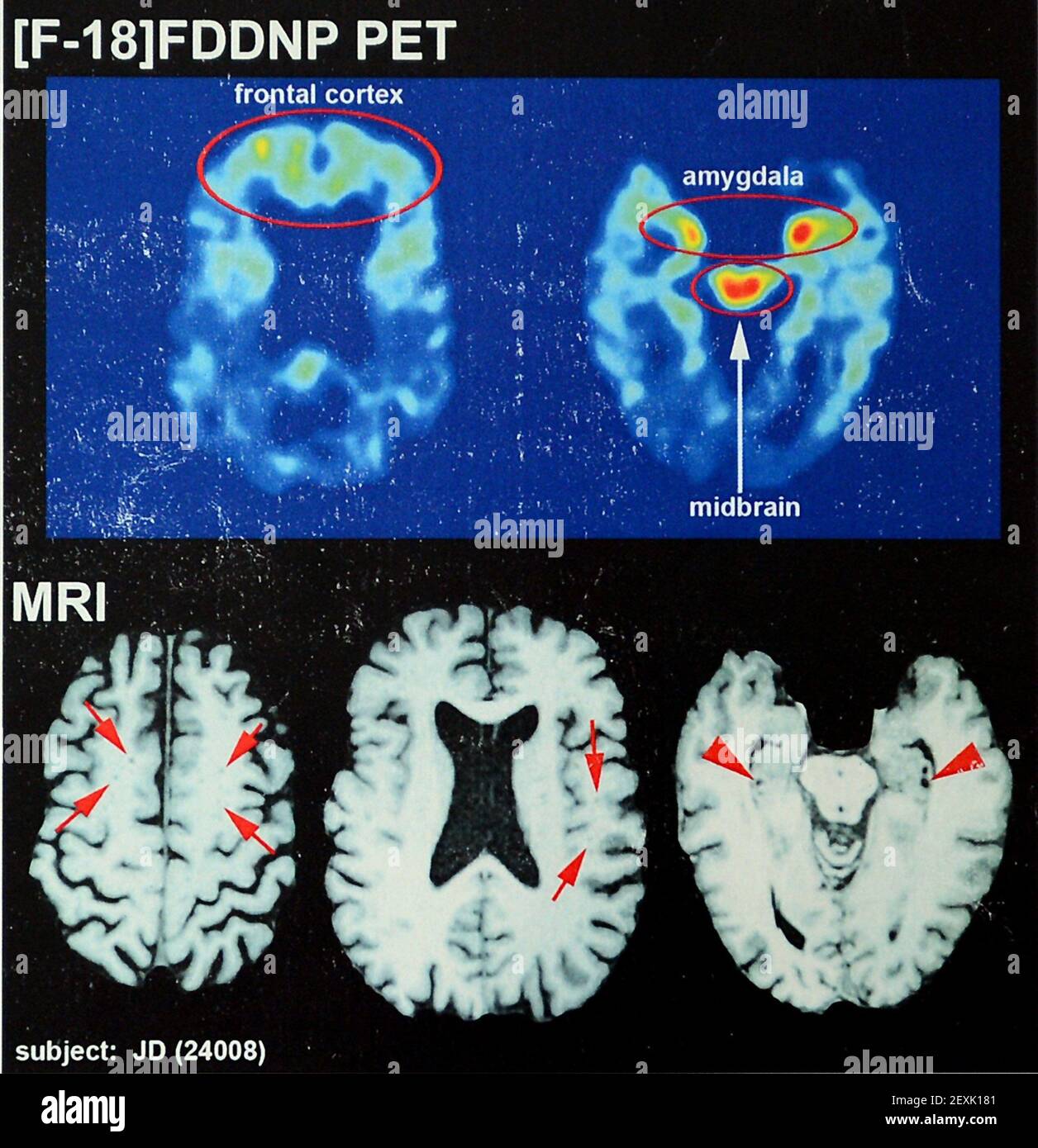 Recent brain scans of NFL hall of famer Joe DeLamielleure, who was ...