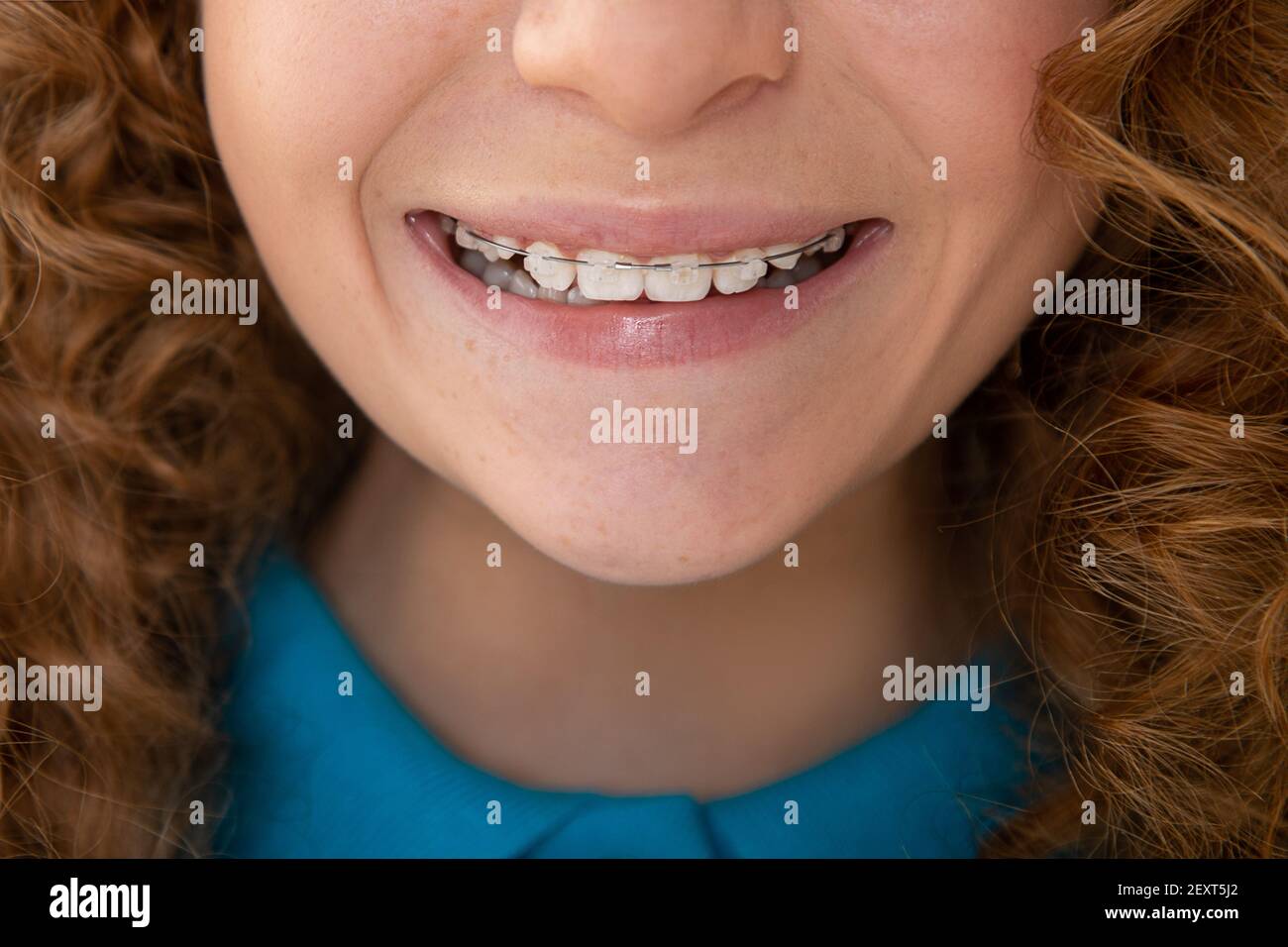 Healthy smile girl with braces, Adolescent. Tooth care dental concept ...