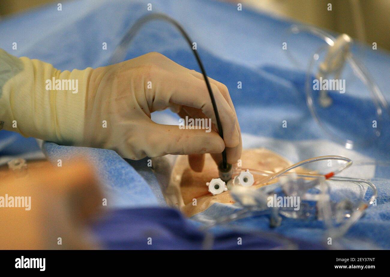 Dr. Joshua Cooper inserts the ultrasound catheter into one of the ...
