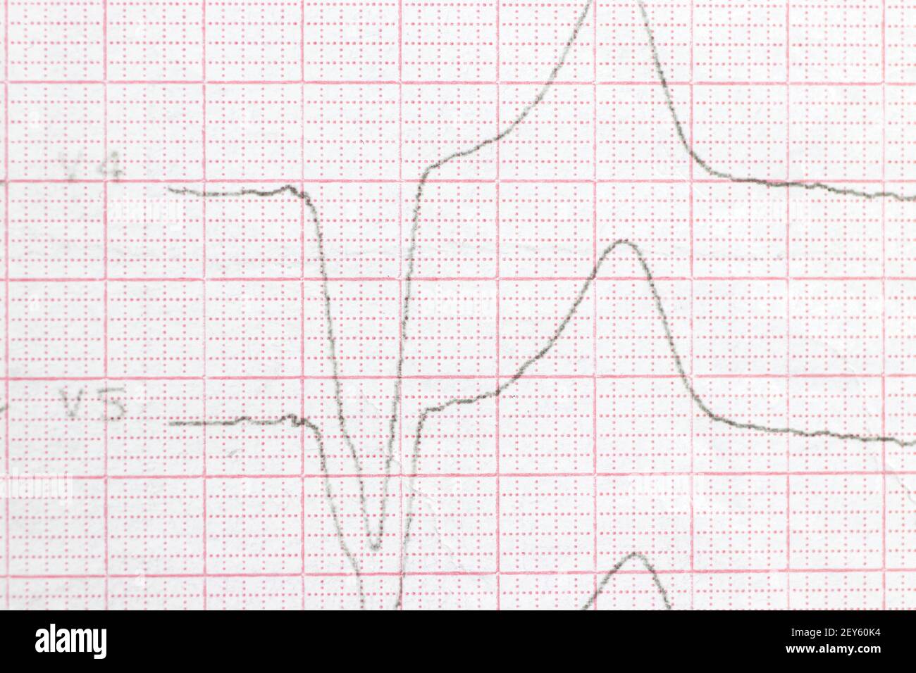 Macro photo of ECG cardiogram of a patient with a heart attack Stock ...