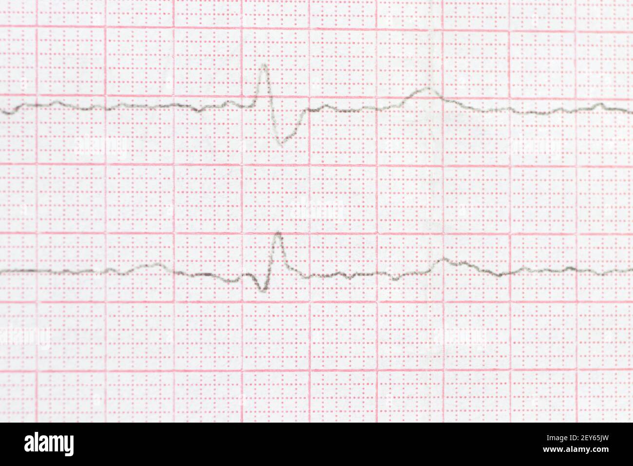Macro or close-up ECG cardiogram of a patient with left bundle branch ...