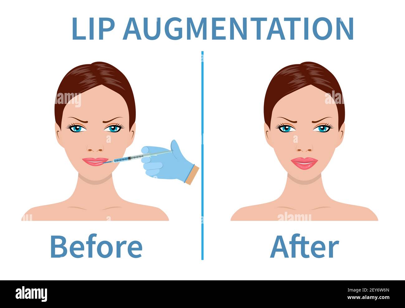 Lip augmentation with hyaluronic acid Stock Vector Image & Art - Alamy