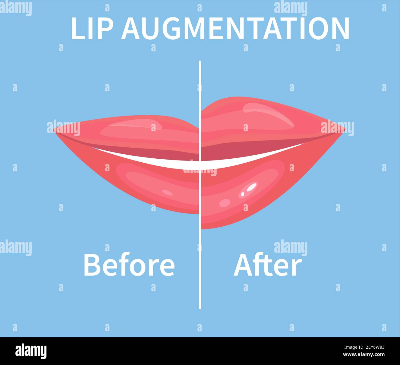 Lip Augmentation. Before and after lip filler injections. Vector ...
