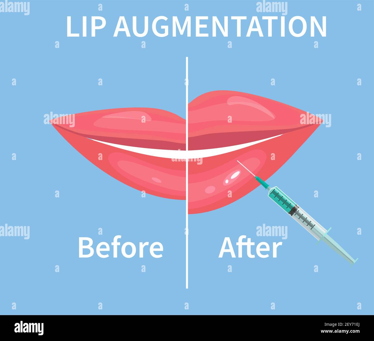 Lip Augmentation. Before and after lip filler injections. Vector ...